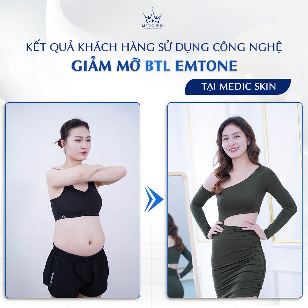 BTL Emtone - Kỉ nguyên của "siết mỡ tăng cơ" thế hệ 2022